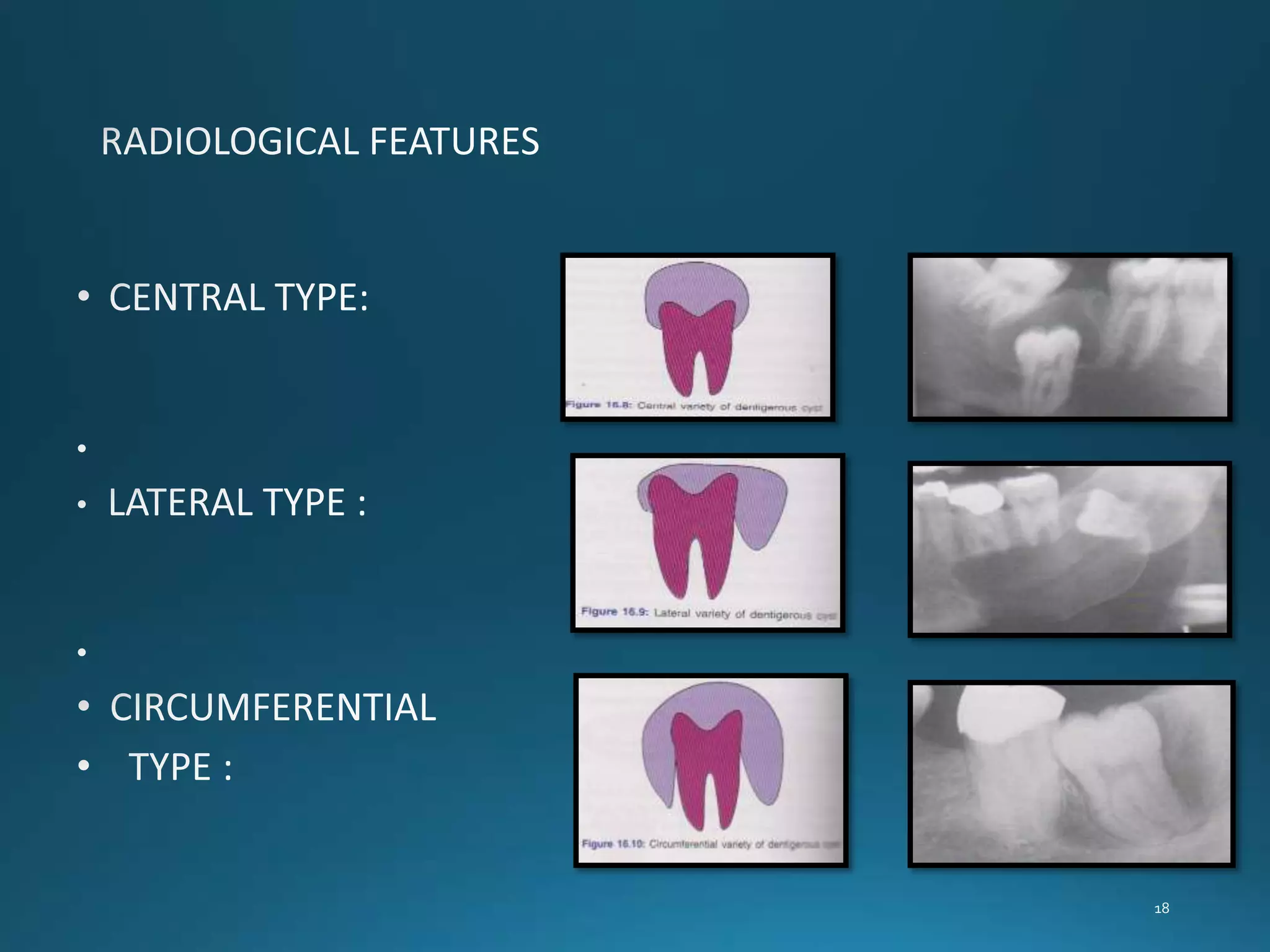 Cysts of Oral Cavity | PPTX