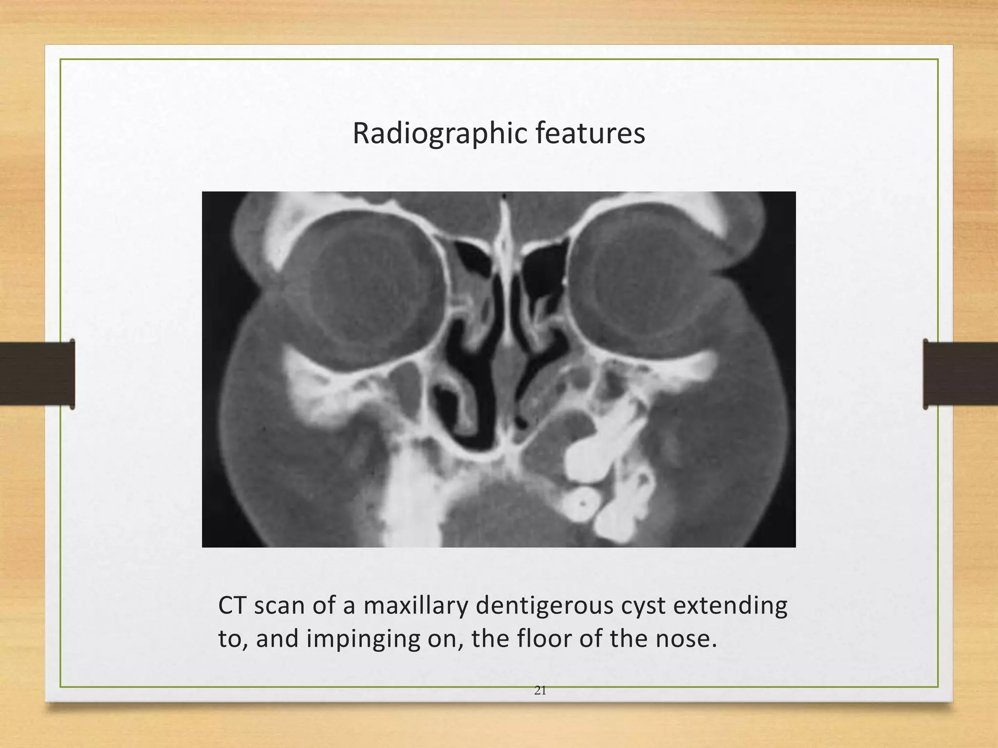 Cysts of Oral Cavity | PPTX