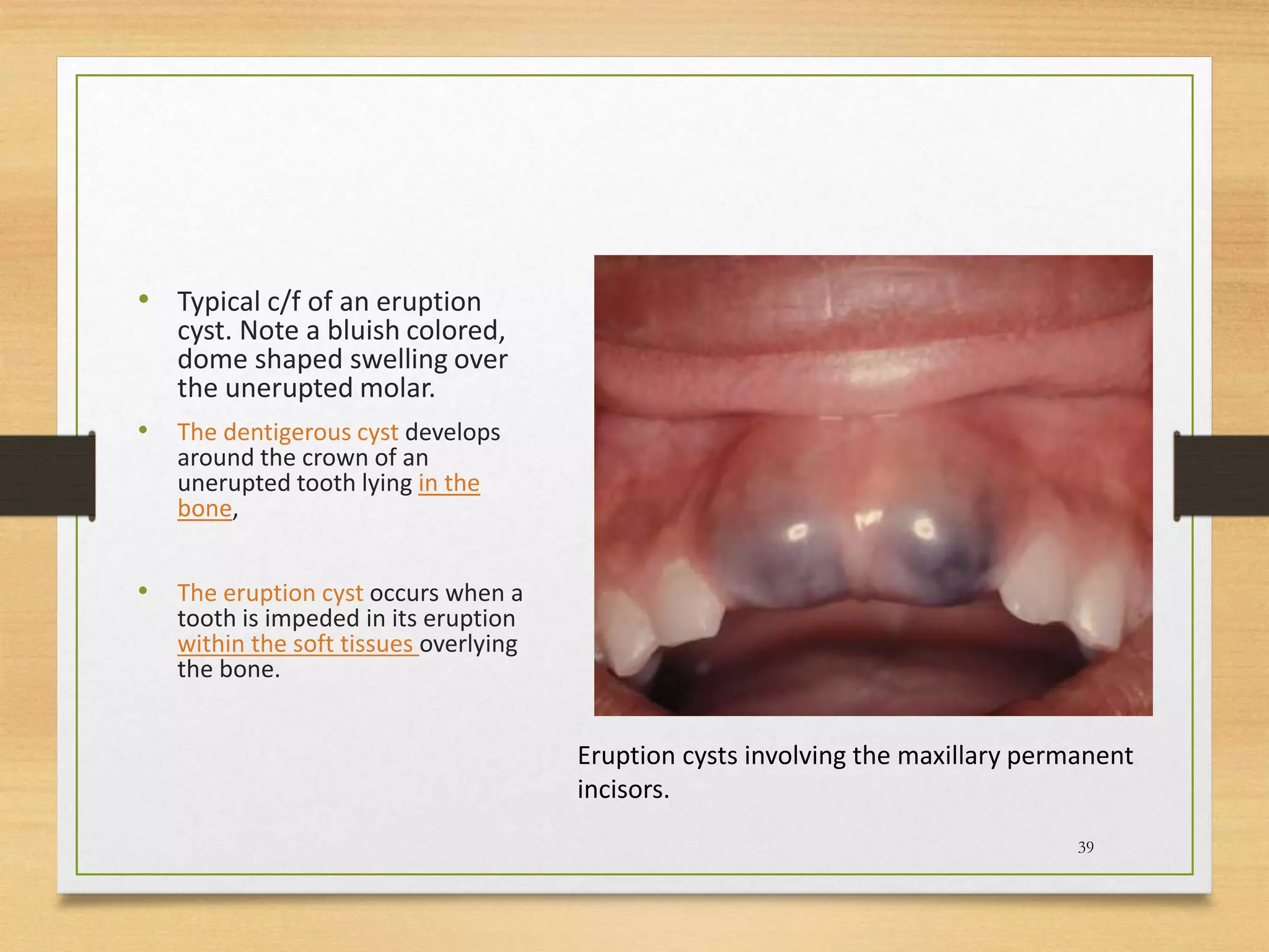 Cysts of Oral Cavity | PPTX