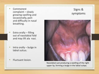 Cysts of Oral Cavity | PPTX