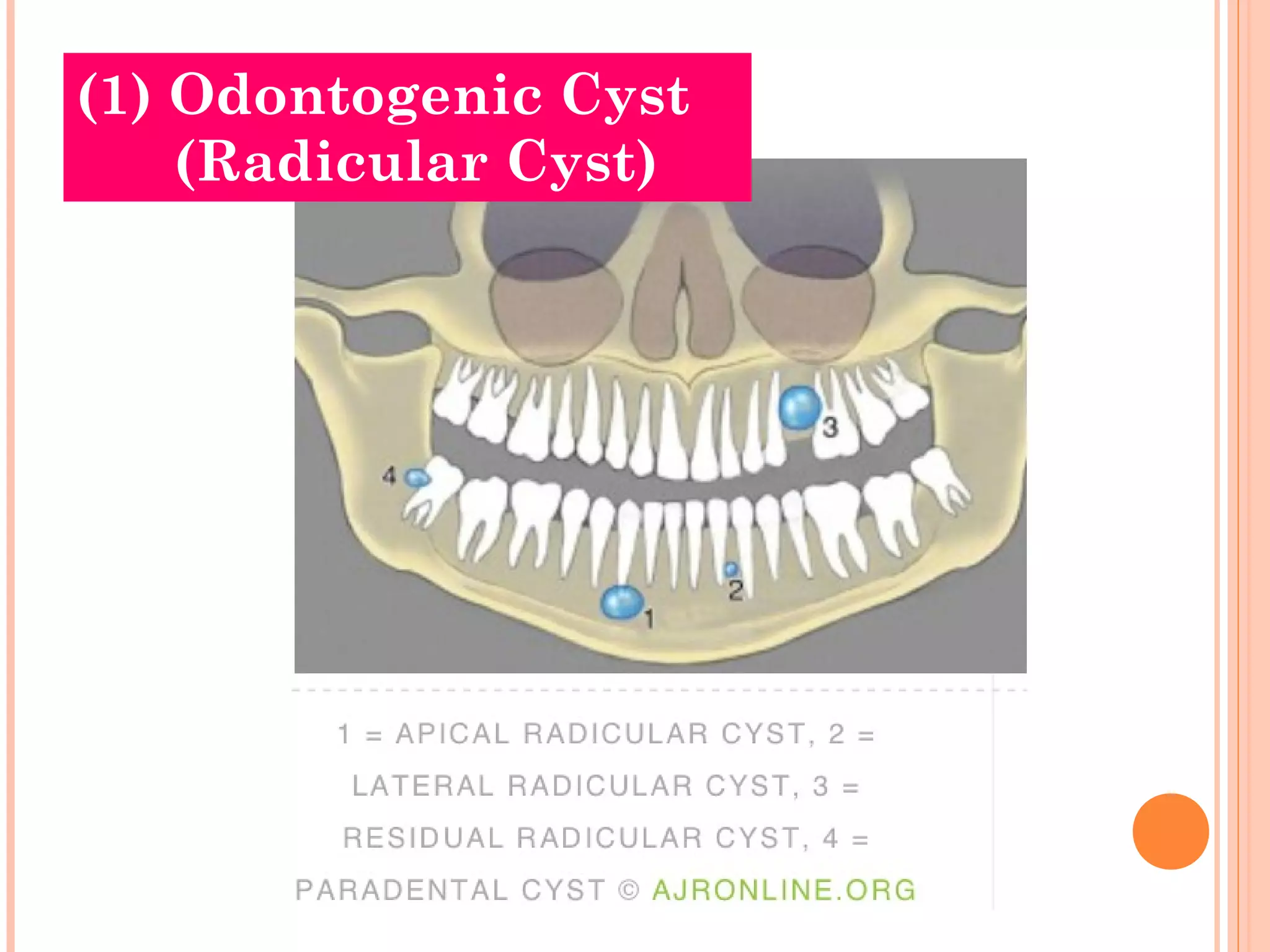 Cysts of oral region (5) | PPT