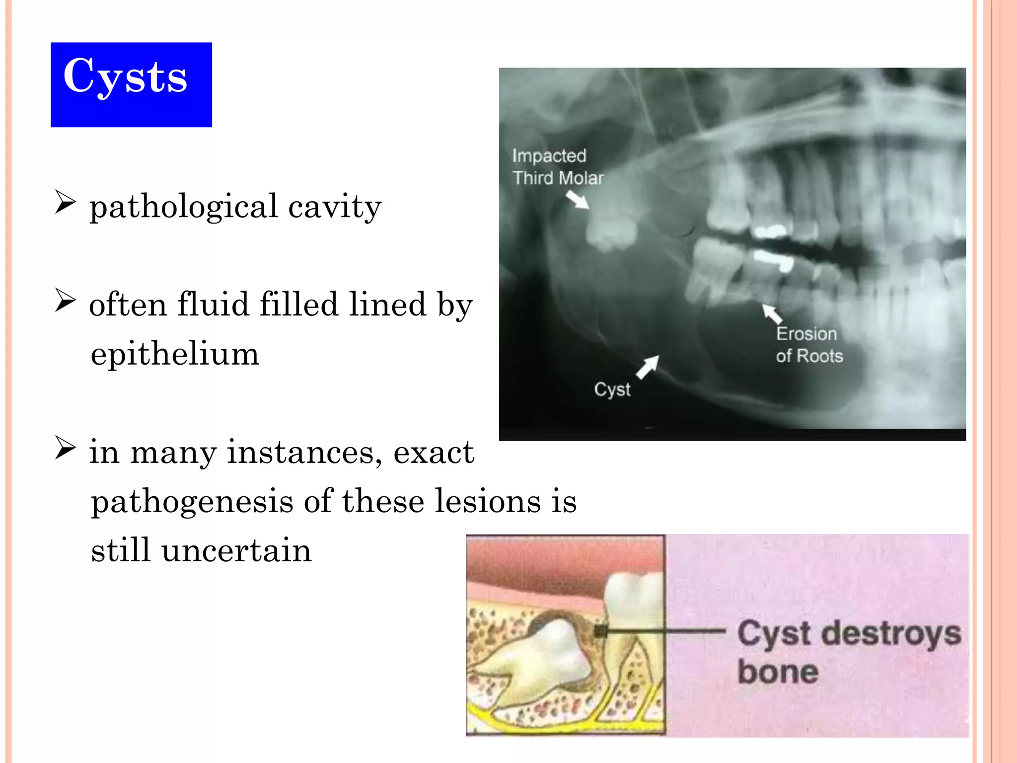 Cysts of oral region (5) | PPT