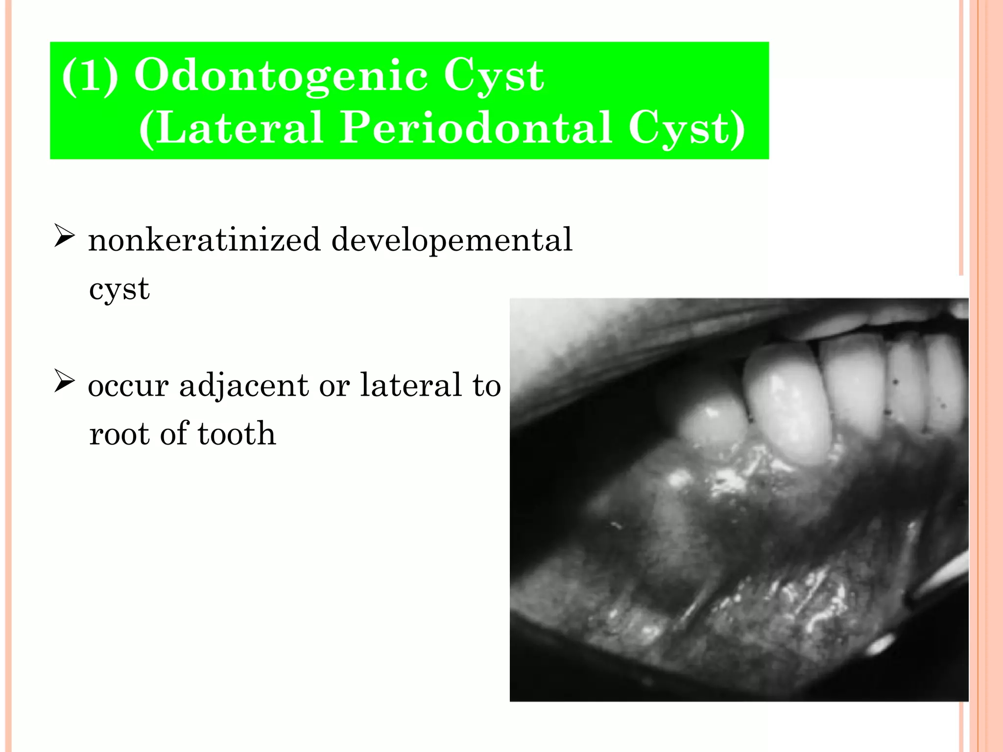 Cysts of oral region (5) | PPT