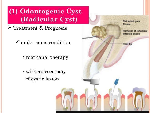 Cysts of oral region (5)