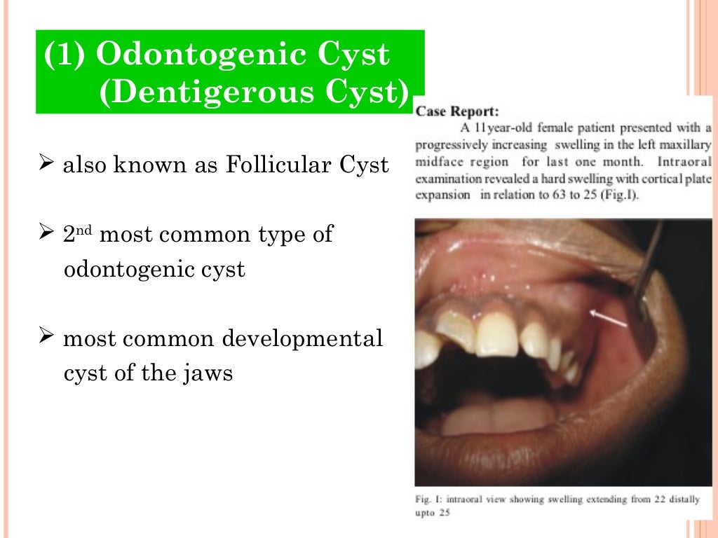 Cysts of oral region (5)