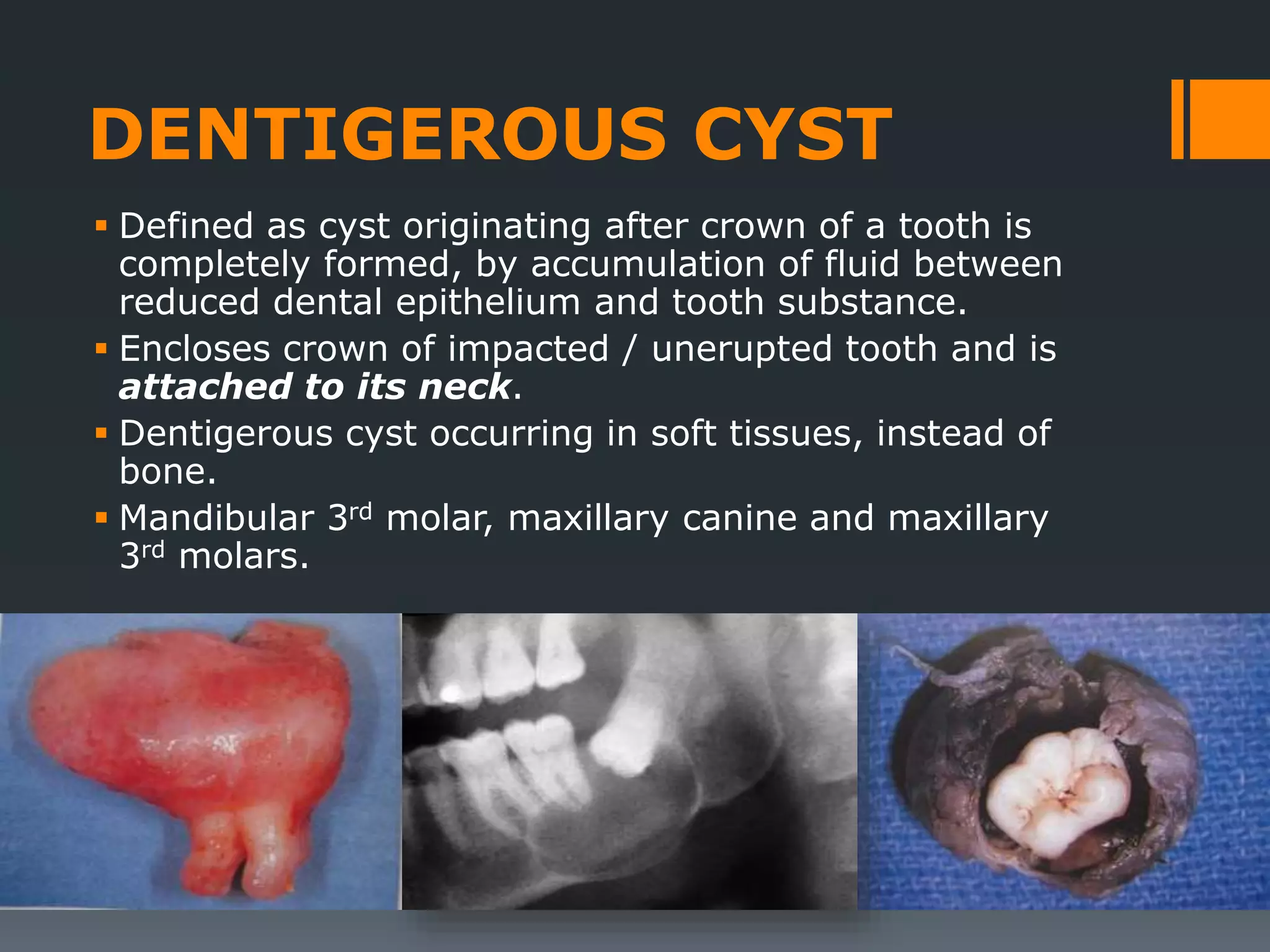 Cysts of oral regions | PPTX