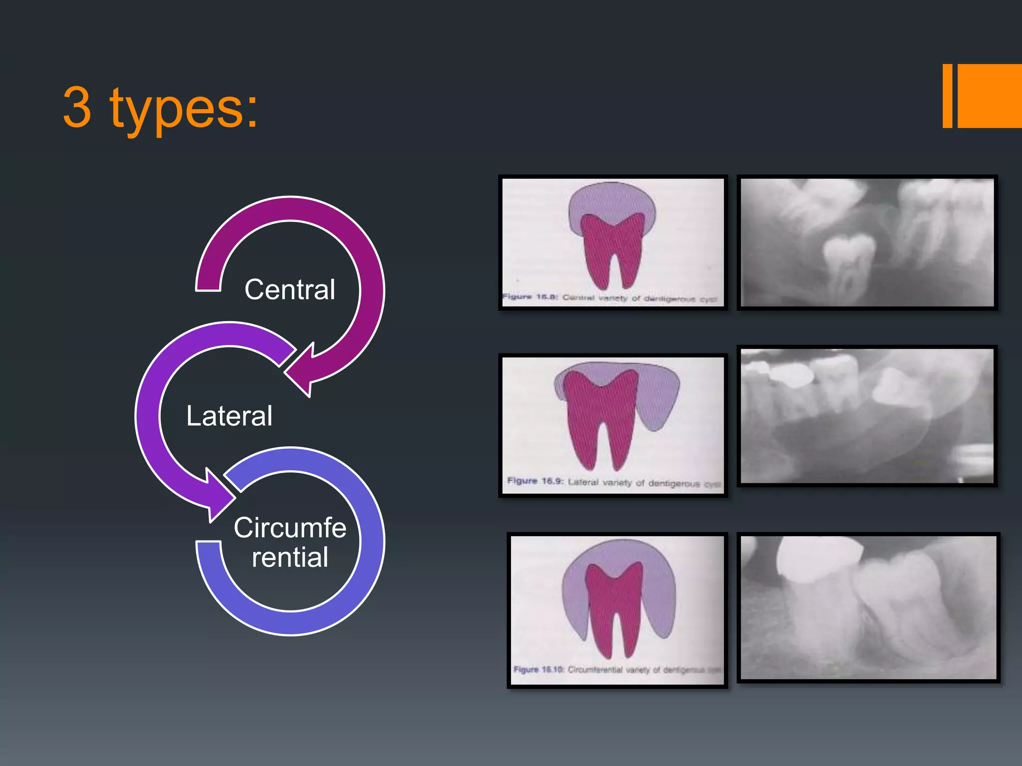Cysts of oral regions | PPTX
