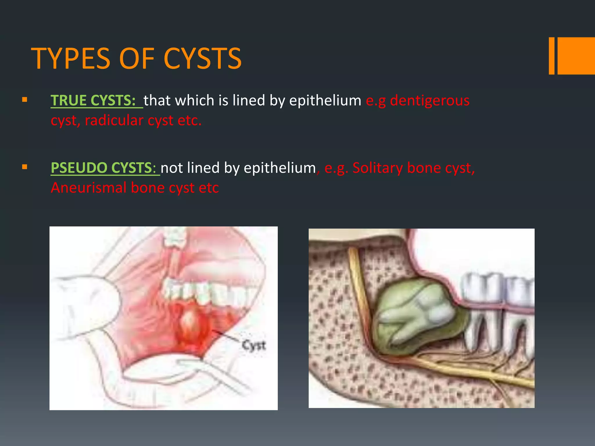 Cysts of oral regions | PPTX