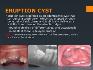 Cysts of oral regions | PPTX