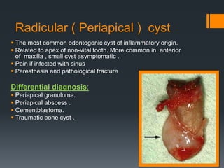 Cysts of oral regions | PPTX