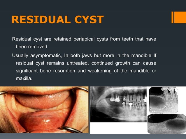 Cysts of oral regions