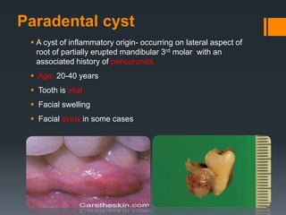 Paradental Cyst