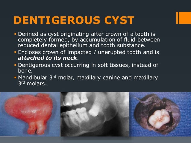 Cysts of oral regions