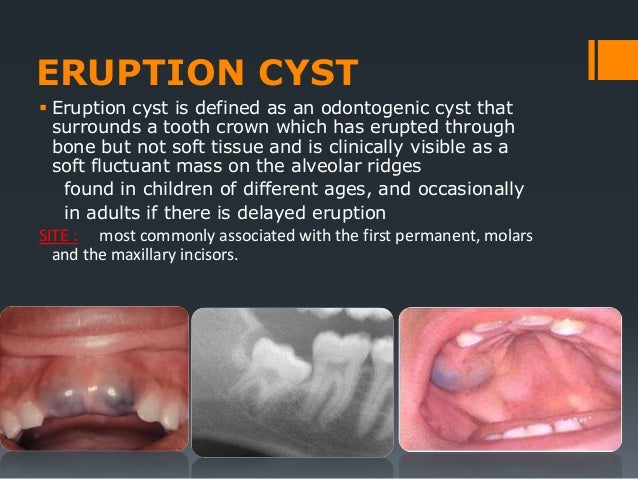 Cysts of oral regions