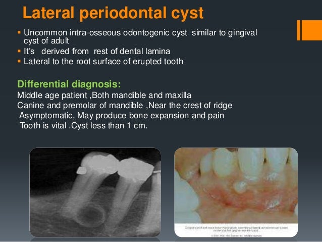 Cysts of oral regions