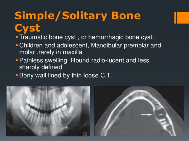 Cysts of oral regions