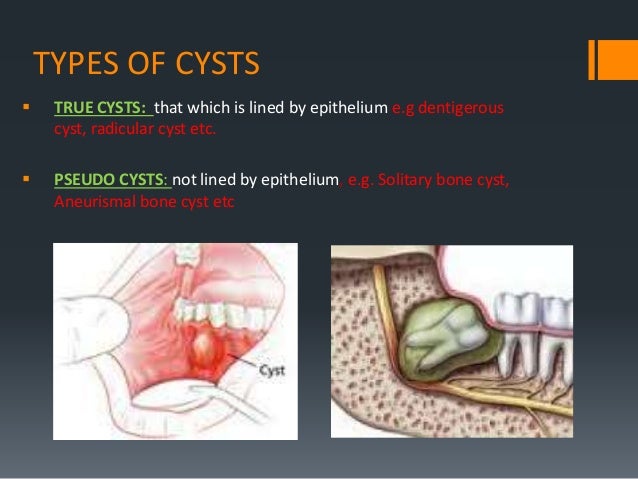 Cysts of oral regions