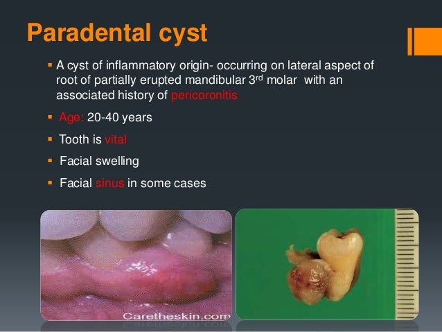 Cysts of oral regions