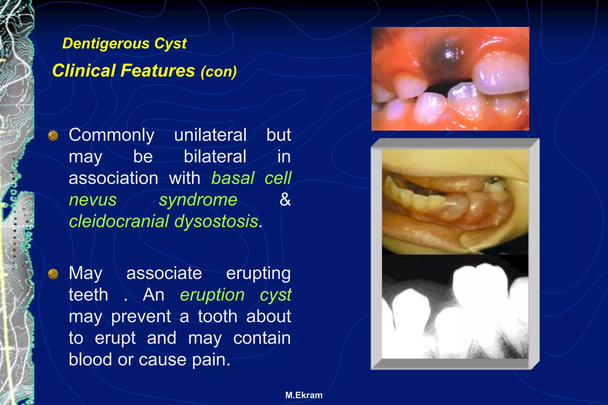 Cysts of the head and neck | PPT