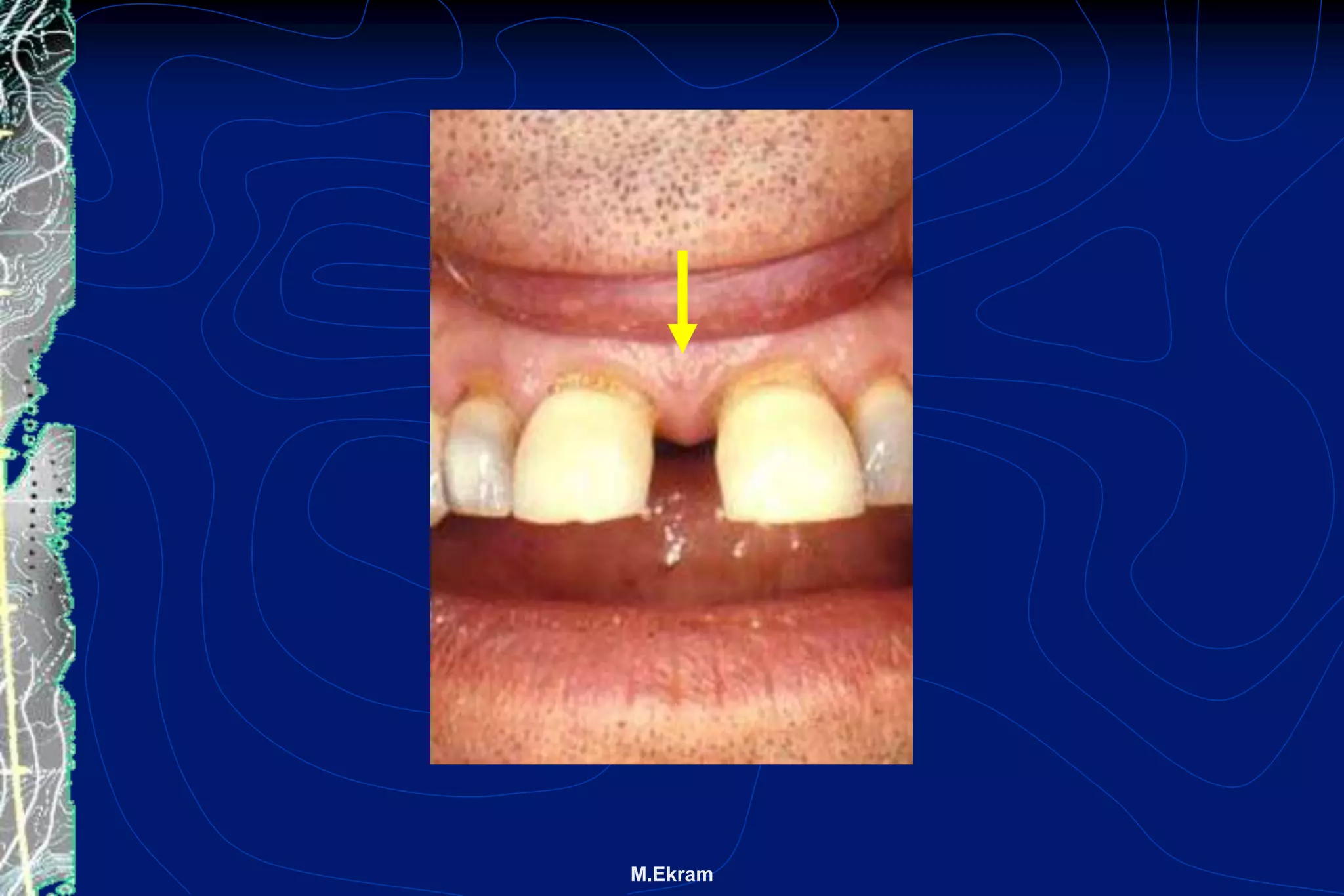 Cysts of the head and neck | PPT