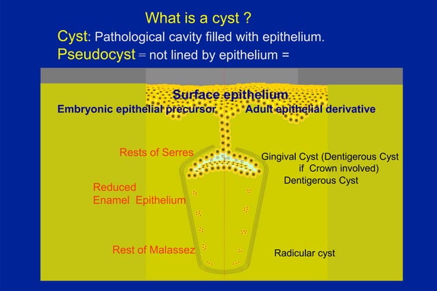 Cysts of the head and neck | PPT | Dental Health | Diseases and Conditions