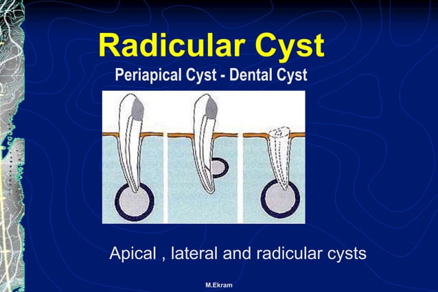 Cysts of the head and neck | PPT | Dental Health | Diseases and Conditions