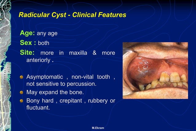 Cysts of the head and neck | PPT | Dental Health | Diseases and Conditions
