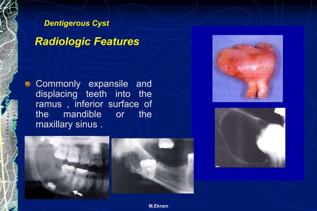 Cysts of the head and neck | PPT | Dental Health | Diseases and Conditions