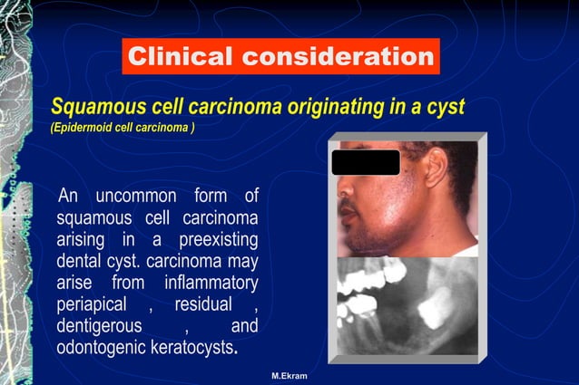 Cysts of the head and neck | PPT | Dental Health | Diseases and Conditions