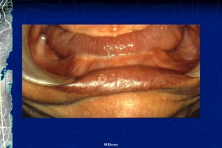 Cysts of the head and neck | PPT