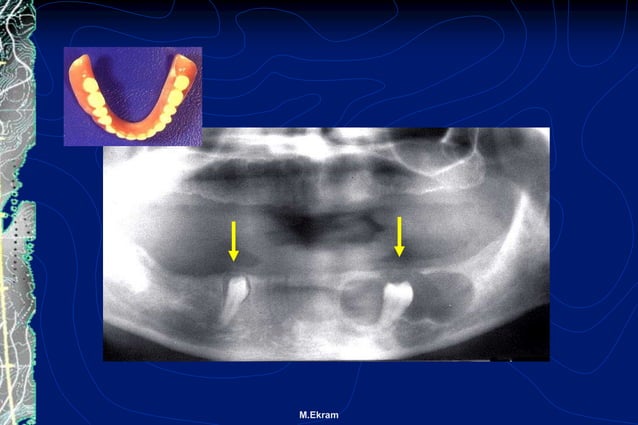 Cysts of the head and neck | PPT | Dental Health | Diseases and Conditions