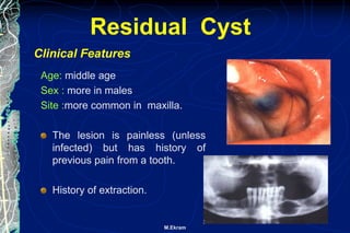 Residual Cyst Clinical