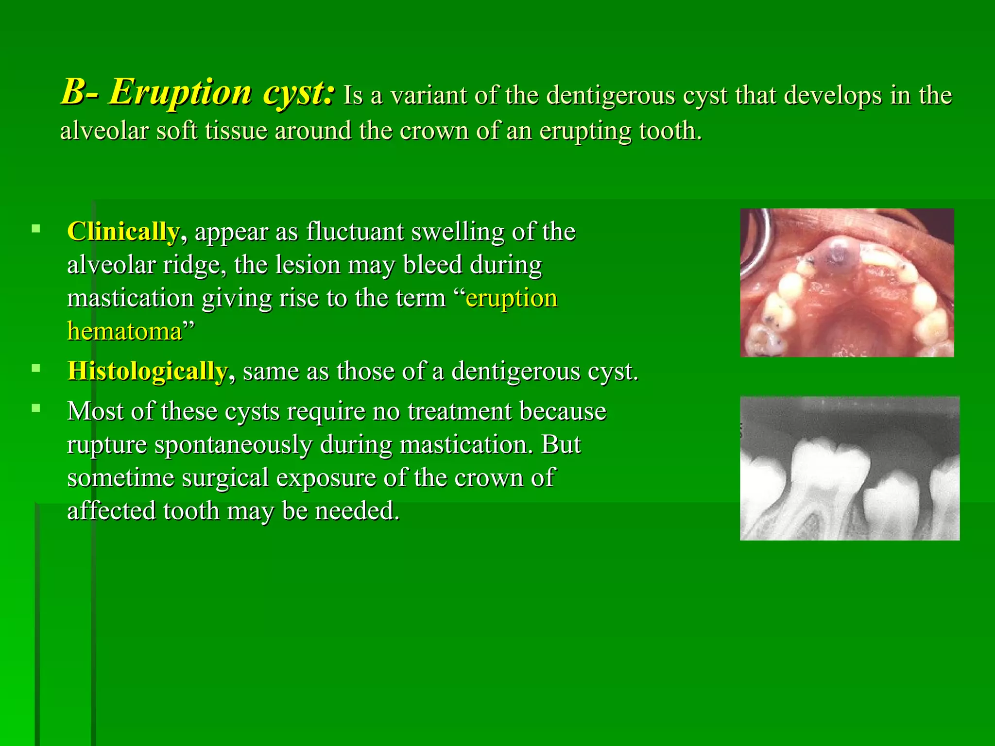 Cysts of the jaw | PPT
