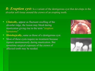 Cysts of the jaw | PPT