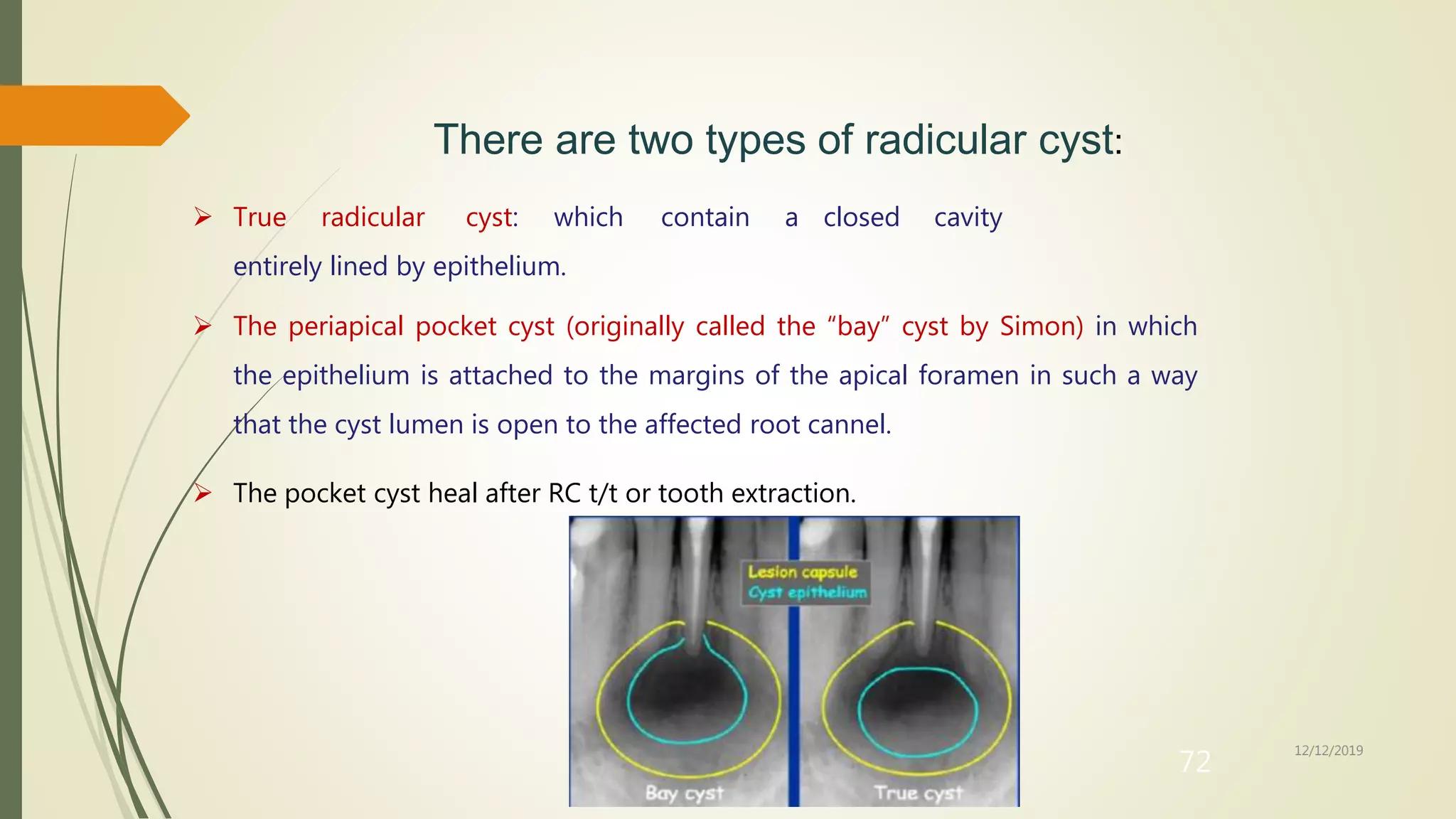Cysts of the jaws | PPTX