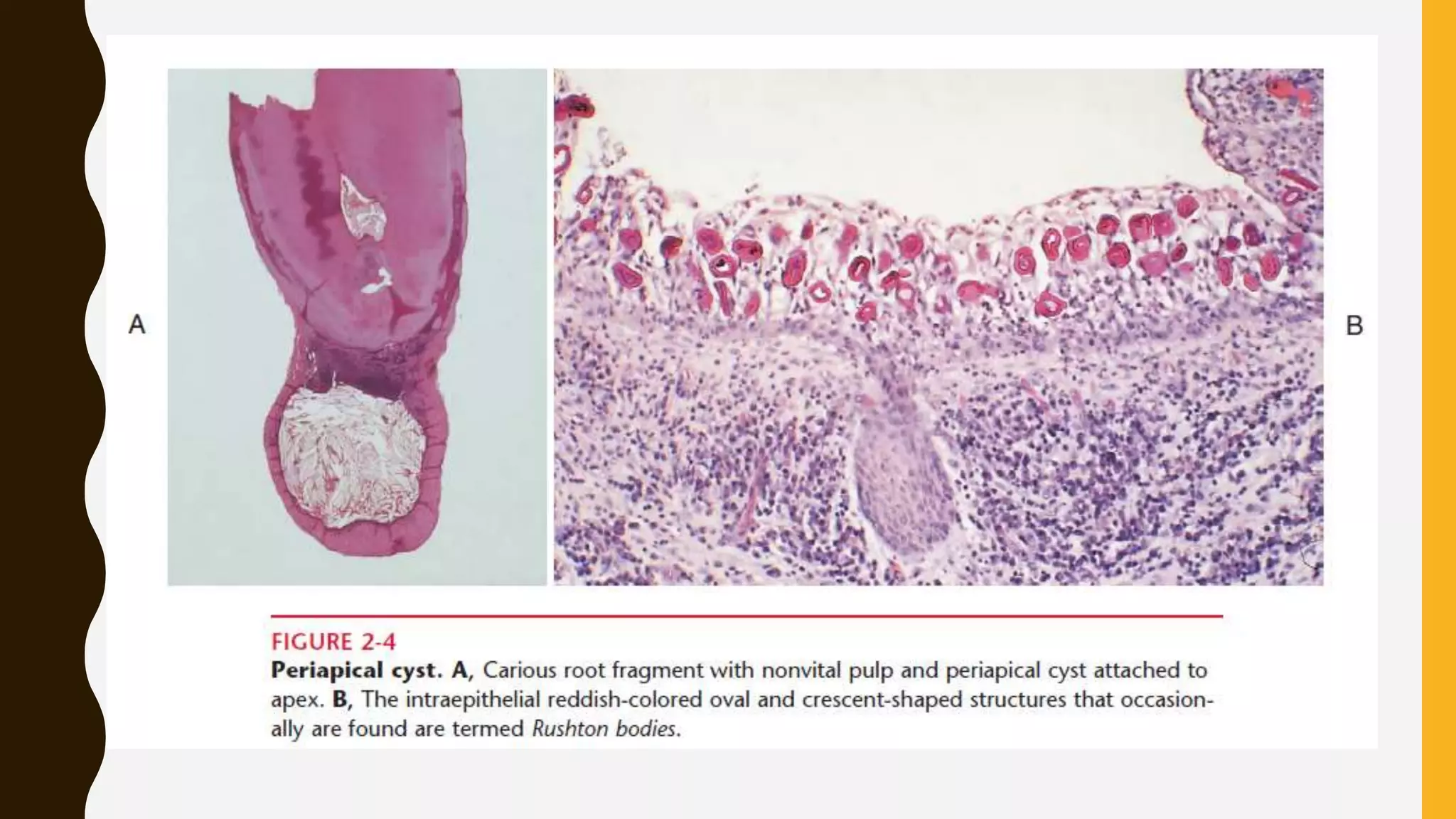Cysts Of The Oral Region - Oral Pathology | PPTX
