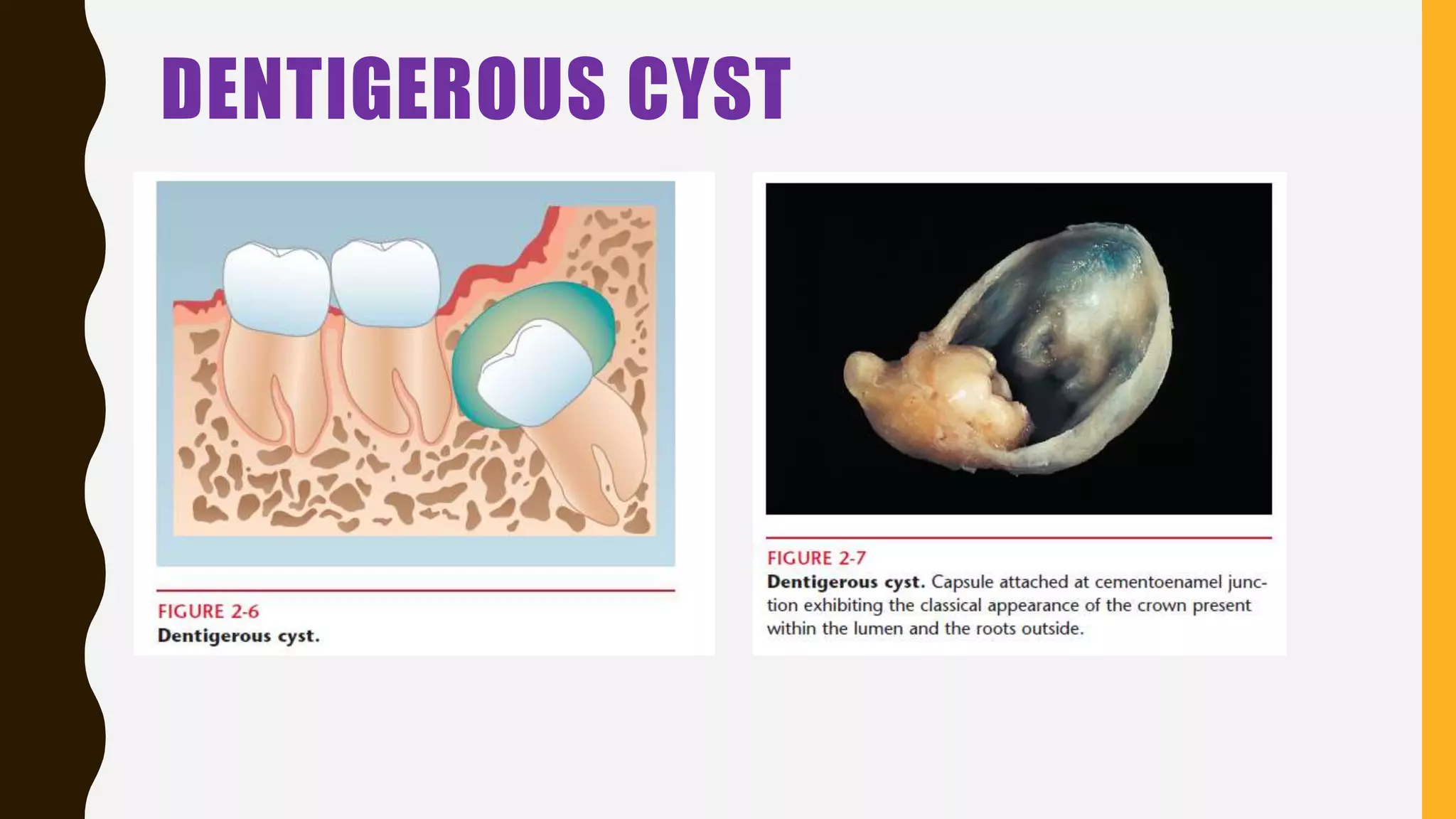 Cysts Of The Oral Region - Oral Pathology | PPTX