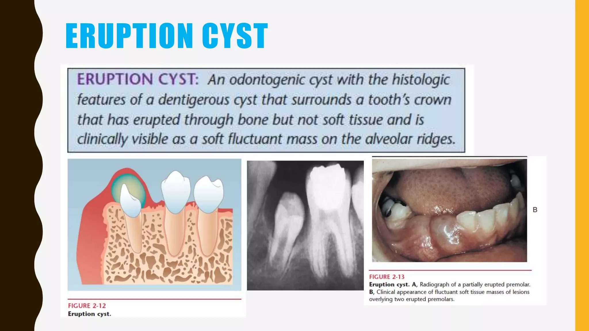 Cysts Of The Oral Region - Oral Pathology | PPTX