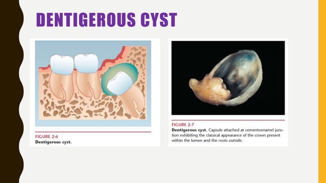 Cysts Of The Oral Region - Oral Pathology | PPTX