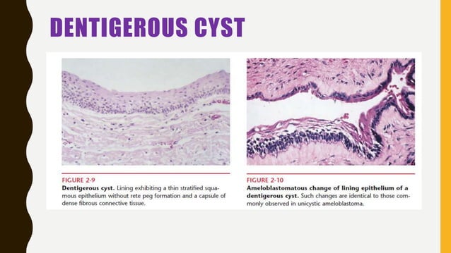Cysts Of The Oral Region - Oral Pathology | PPTX
