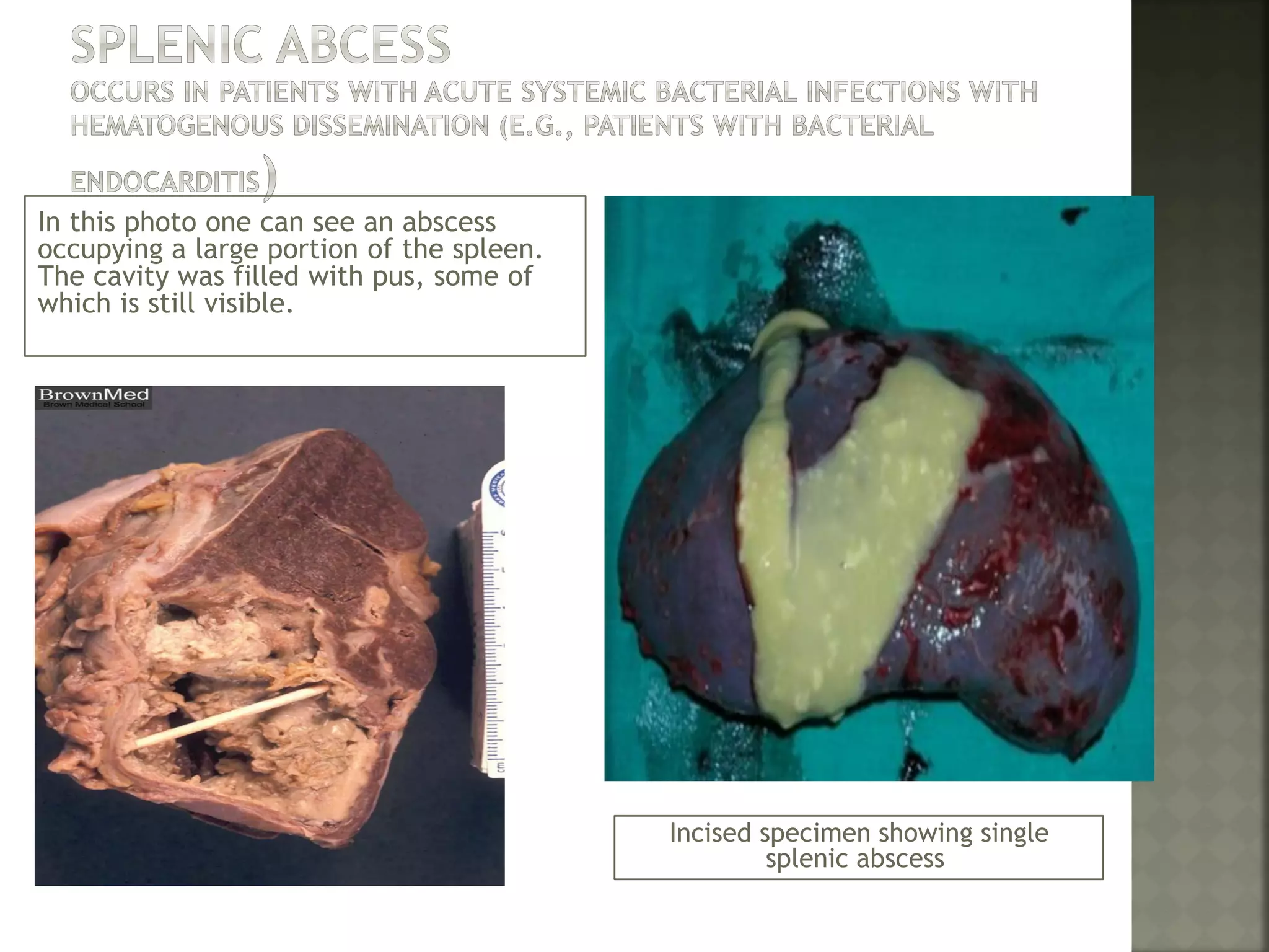 Cysts of the spleen | PDF