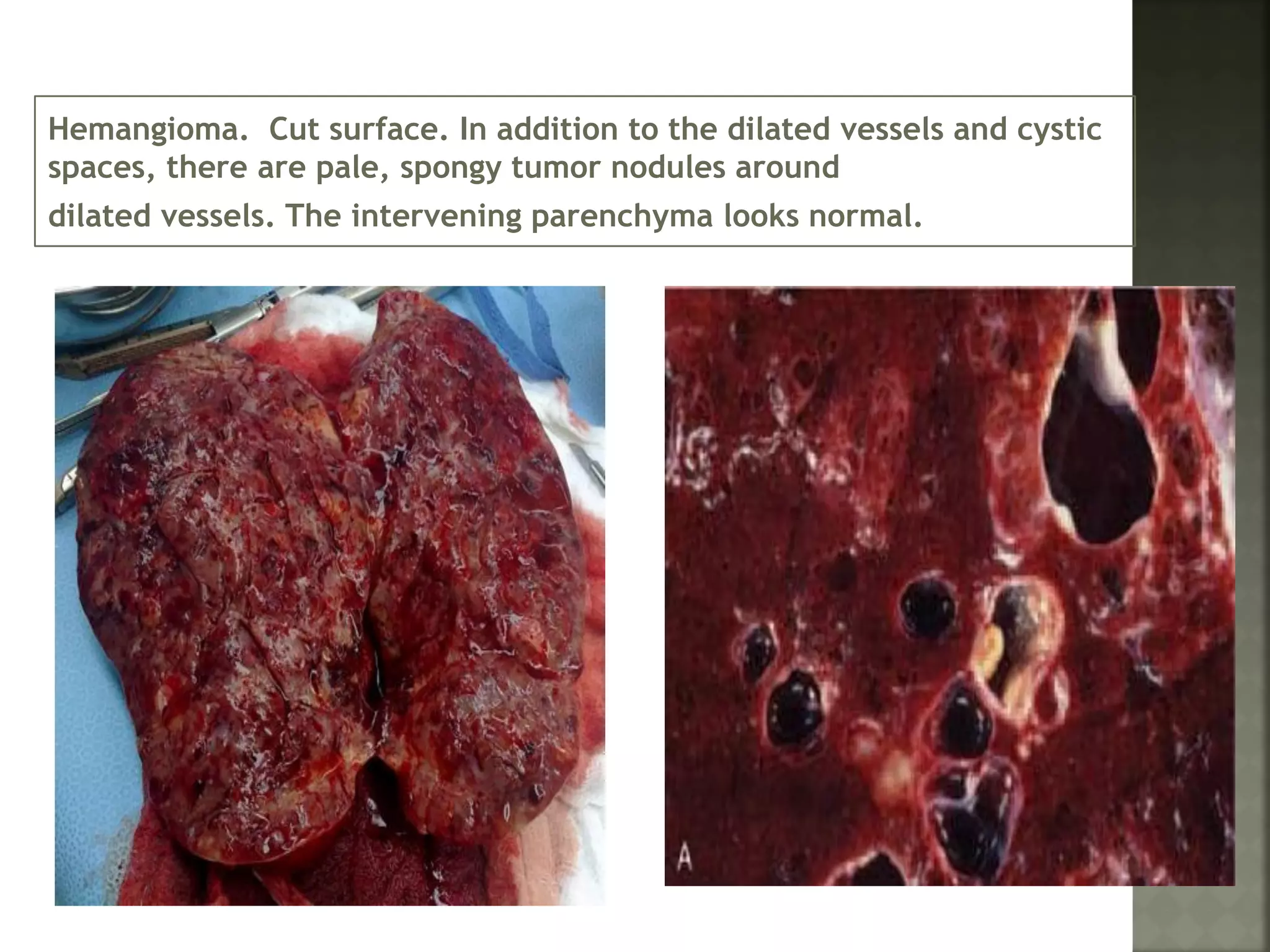 Cysts of the spleen | PDF