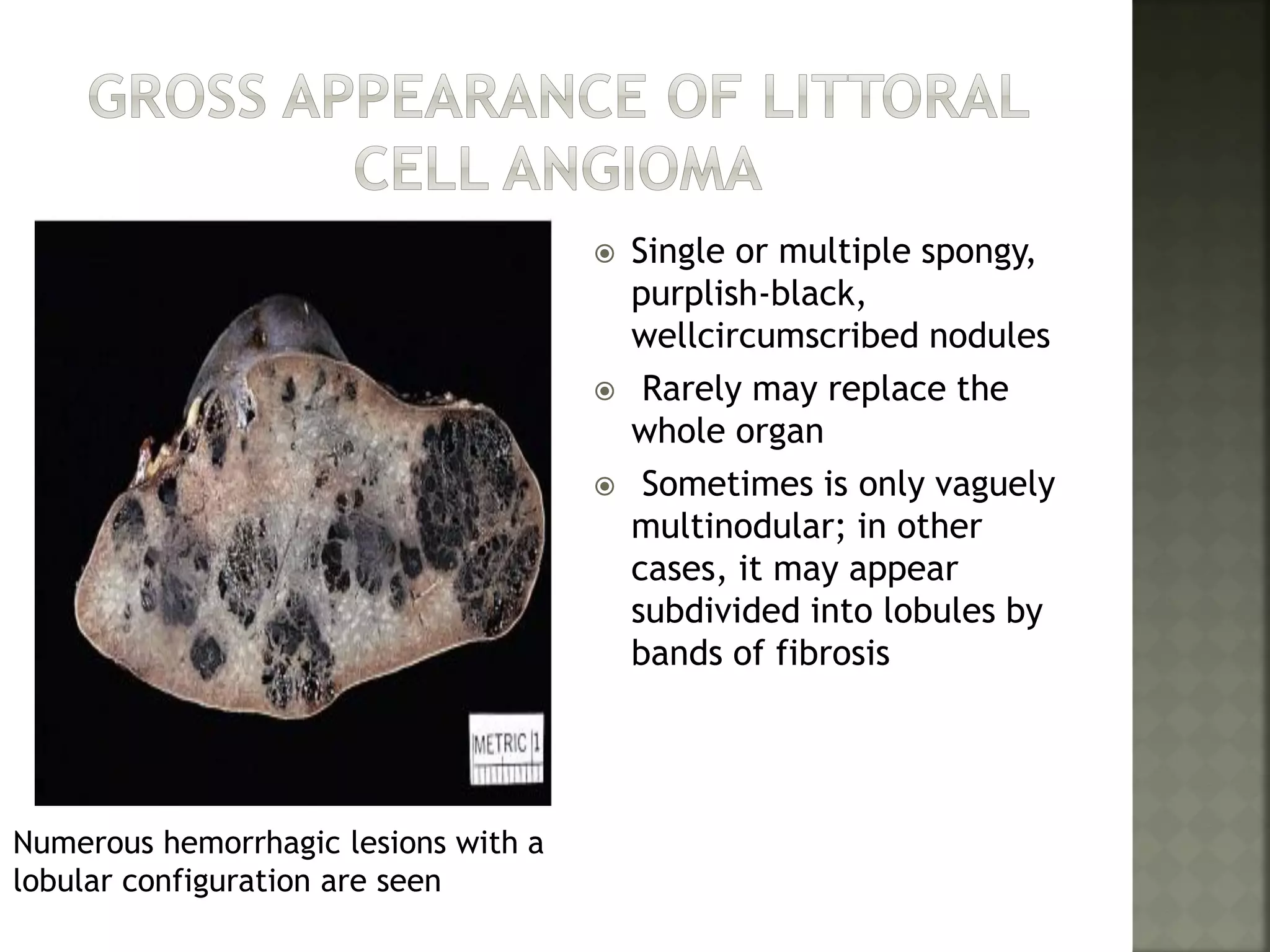 Cysts of the spleen | PDF