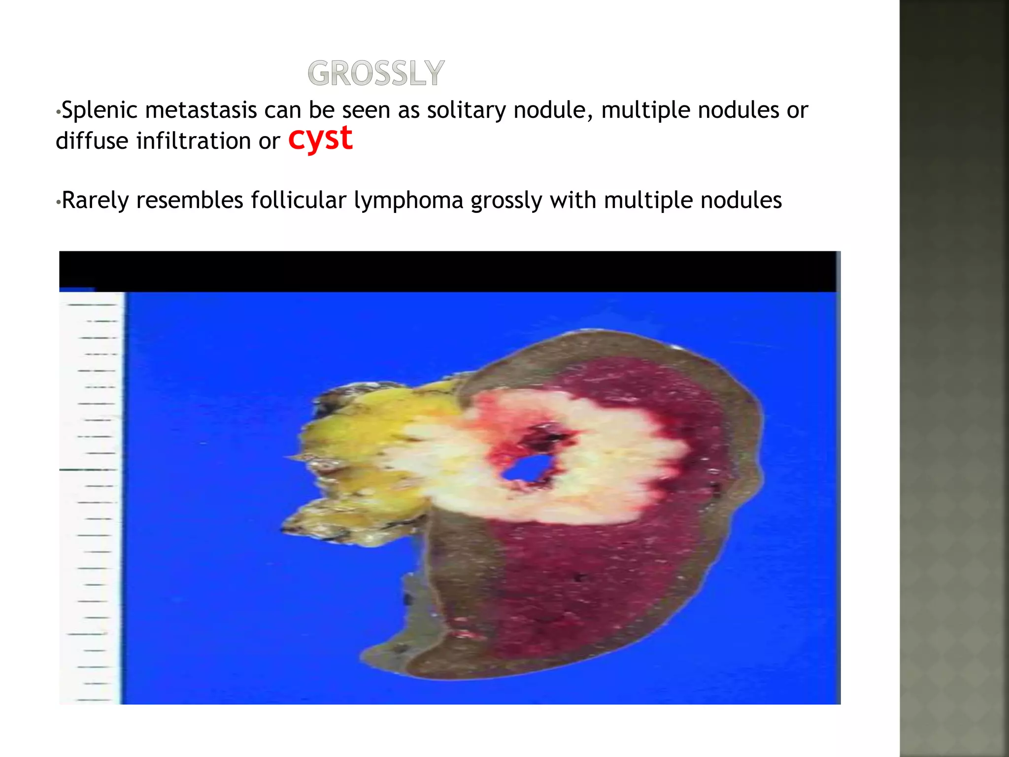 Cysts of the spleen | PDF