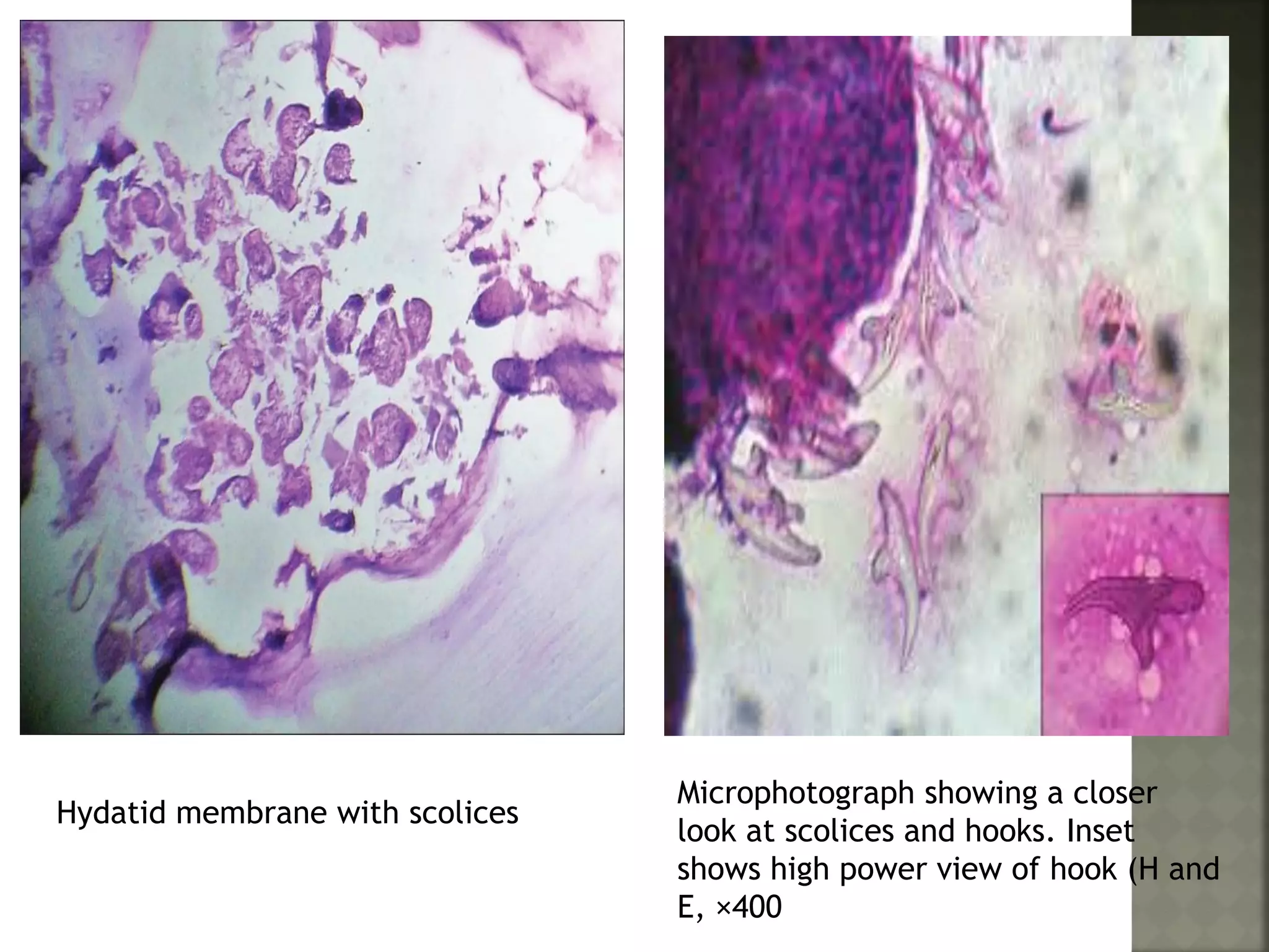 Cysts of the spleen | PDF