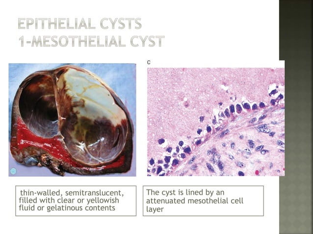 Cysts of the spleen | PDF