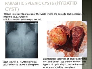 Cysts of the spleen | PDF