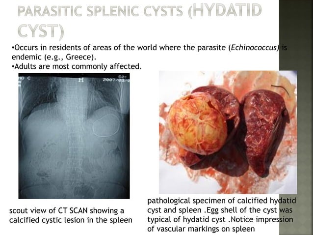 Cysts of the spleen | PDF