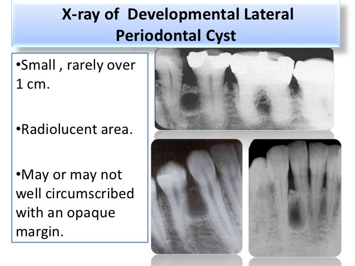 Cysts part 1