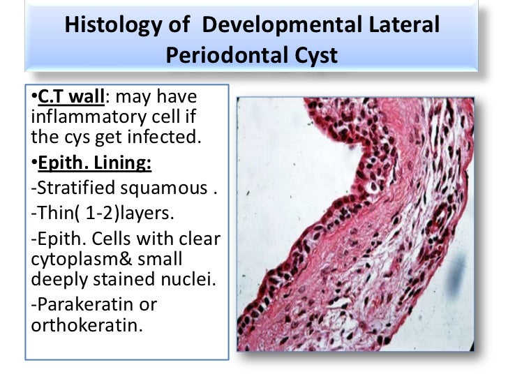 Lateral Periodontal Cyst Histology Unusual Histological Presentation